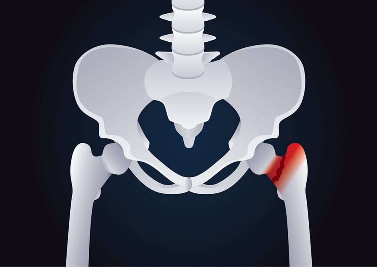 Four Tips for Protecting Your Senior’s Bones - Prime Home Health